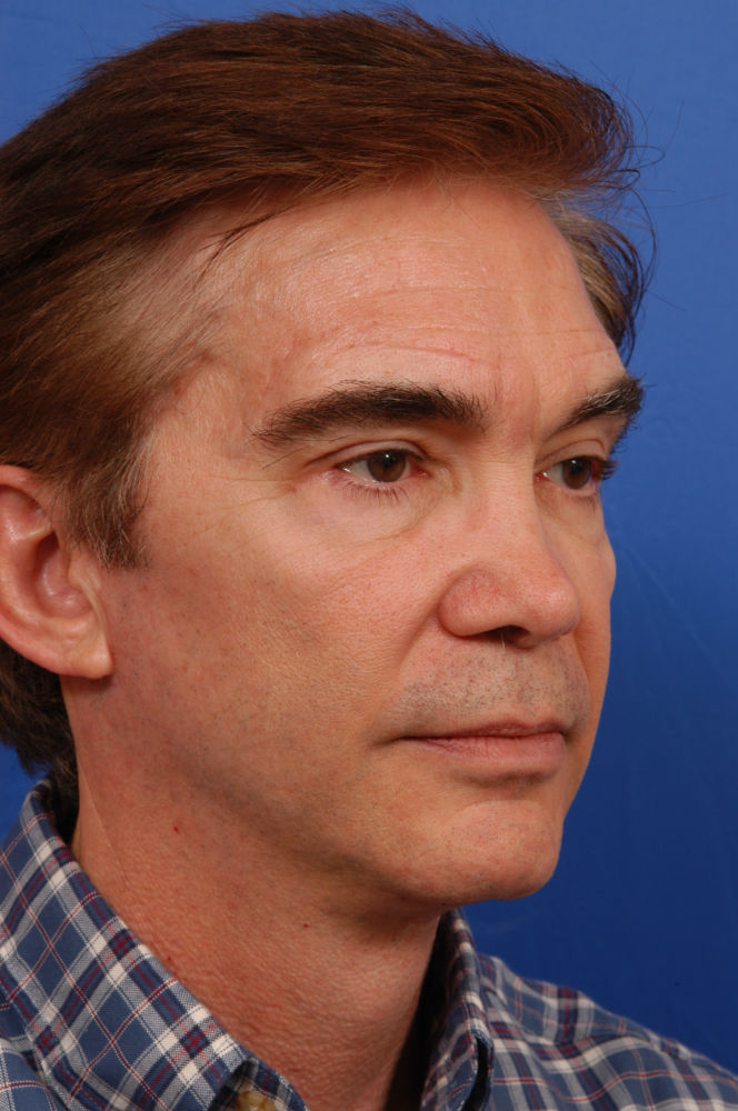 Before and After Photos Denver - Plastic Surgery Gallery Dr. John Millard