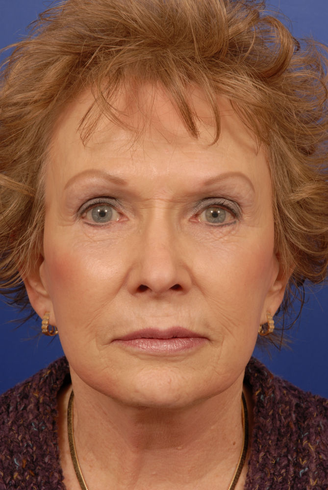 Before and After Photos Denver - Plastic Surgery Gallery Dr. John Millard